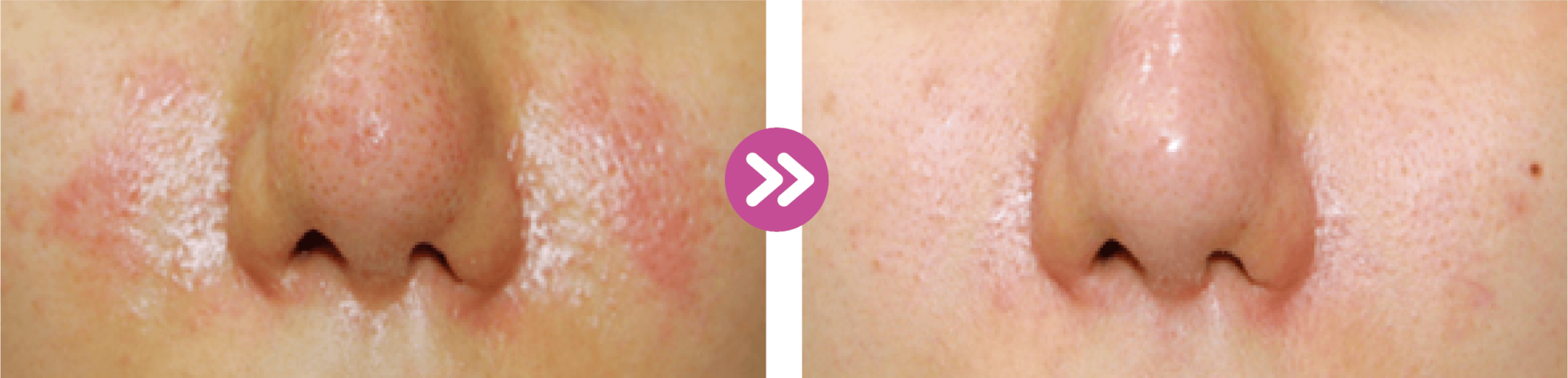 SUPERFICIAL Pink Aging - RIBESKIN Anti Aging Treatment