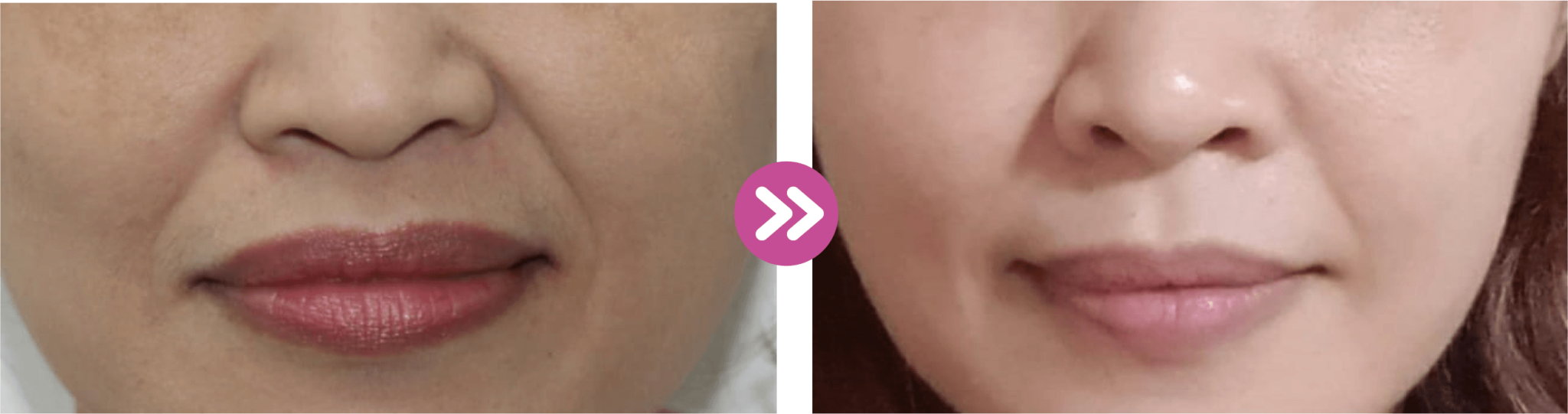 SUPERFICIAL Pink Aging - RIBESKIN Anti Aging Treatment