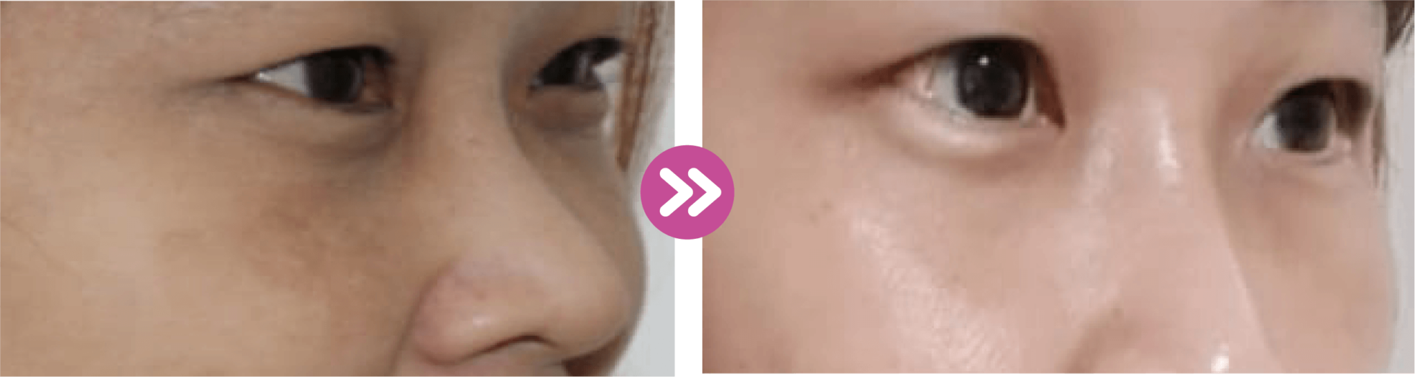 Pink Aging Vial - RIBESKIN Anti Aging Mesotherapy