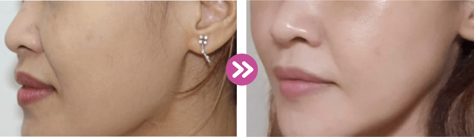 Pink Aging Vial - RIBESKIN Anti Aging Mesotherapy