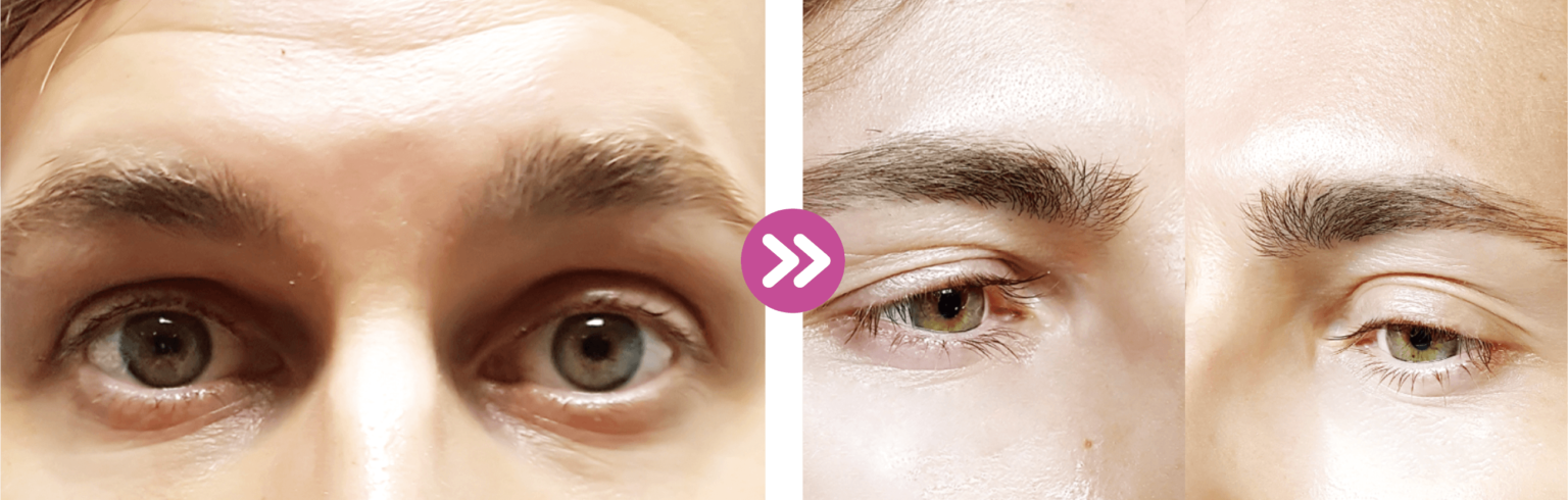 Pink Aging Vial - RIBESKIN Anti Aging Mesotherapy