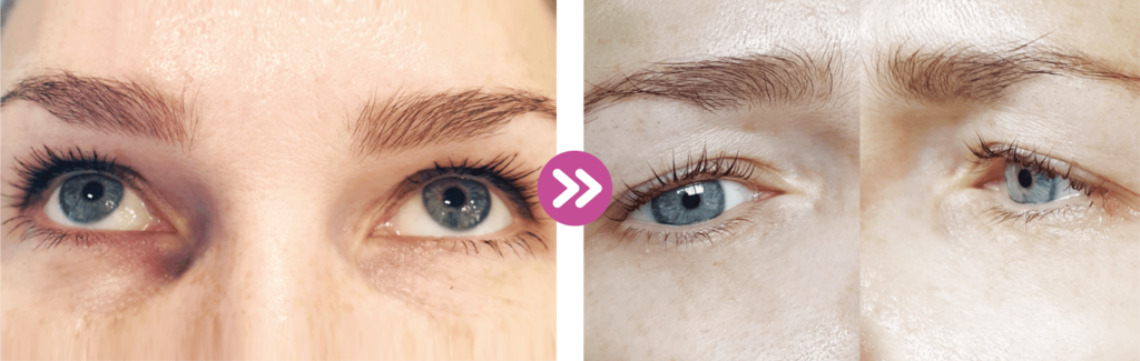 Pink Aging Vial - RIBESKIN Anti Aging Mesotherapy